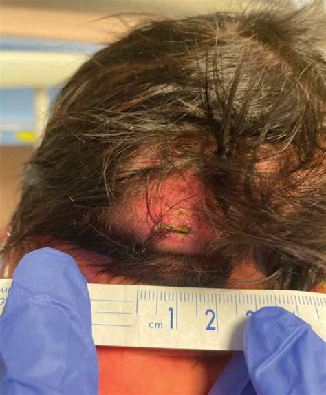 Occipital Scalp Nodule In A Newborn Mdedge Dermatology