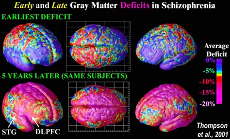 Structural Brain Abnormalities