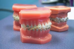 Rubber Bands With Braces Don T Forget To Wear Your Elastics Fravel Brewer Orthodontics