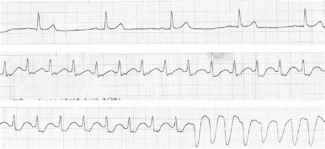Heart Rate Monitor Before And During Ventricular Tachycardia