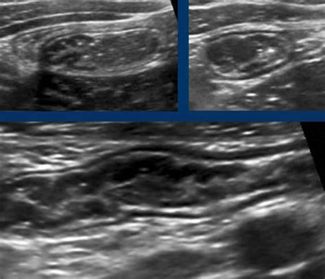 Terminal Ileum Ultrasound
