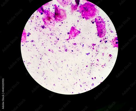 Staphylococcus Aureus Gram Stain 100x
