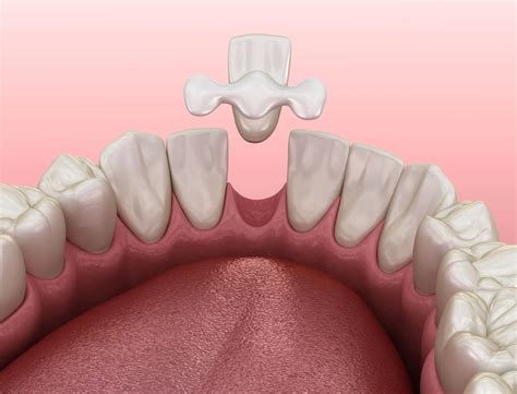 Maryland Bridge London Resin Bonded Bridge From £515 South Kensington
