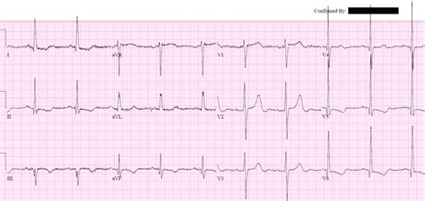 T Wave INVERSION Mnemonic ECG Cases Emergency Medicine Cases