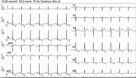 Baseline Ecg At Admission Ecg Electrocardiogram Download