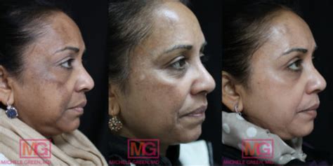 Cosmelan Cosmelan Peel And Melasma Treatment Nyc