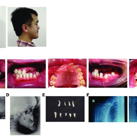 Mutation Analysis Of The RUNX2 Gene In A 23 Year Old Patient With Download Scientific Diagram
