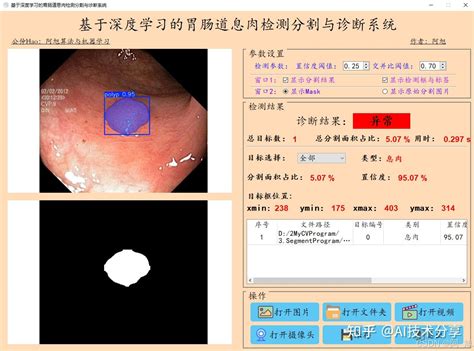 基于yolo11深度学习的胃肠道息肉智能检测分割与诊断系统【python源码 pyqt5界面 数据集 训练代码】深度学习实战、目标分割、人工