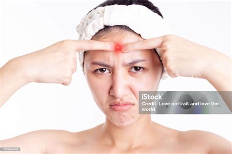 큰 여드름 여드름 또는 미용 소녀 얼굴에 결점 아름다운 젊은 아시아 여자는 염증 여드름이나 농포 여드름을 터지는 여드름은 호르몬 변화에서 발생합니다 젊은 아가씨 압착 여드름