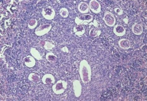 Histological Section Staining With Hematoxylin And Eosin For Infected