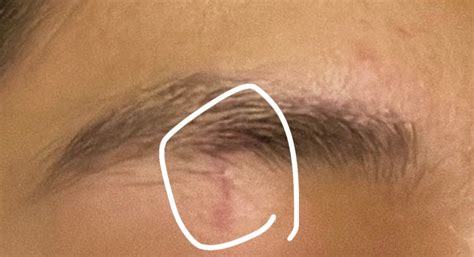 눈 위 핏줄 지식in