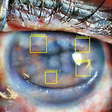 Post Mortem Iris Decomposition And Its Dynamics In Morgue Conditions
