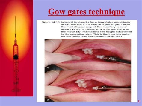 Local Anesthesia In Dentistry
