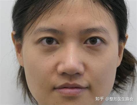 泪沟鼻基底凹陷怎么改善老路列举真实案例进行讲解 知乎