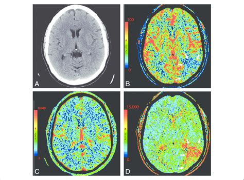 Ct Data From A Patient Who Suffered A Left Mca Territory Acute Ischemic Download Scientific