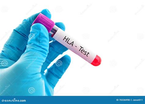 HLA Test Stock Photo Image Of Illness Attention Failure