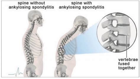 Ankylosing Spondylitis