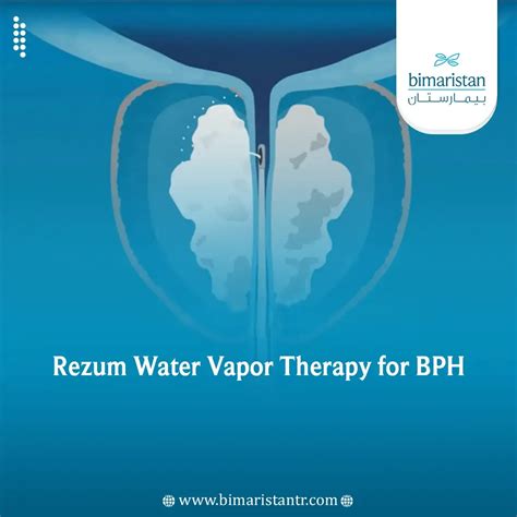 Rezum Therapy For Prostate Without Surgery 2025