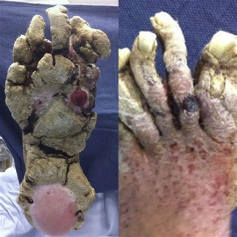 Norwegian Scabies Crusted Scabies Is An Acariasis Caused By A Severe