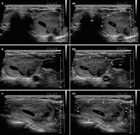 complex nodule radiology key