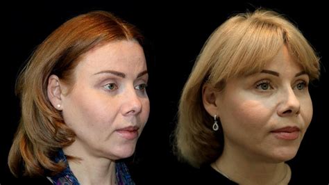 Круговая подтяжка лица → Фото результатов до и после пластической операции