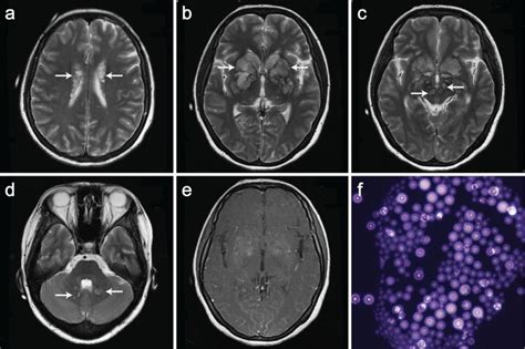 Magnetic Resonance Imaging Features Of Gelatinous Pseudocysts In Cryptococcal