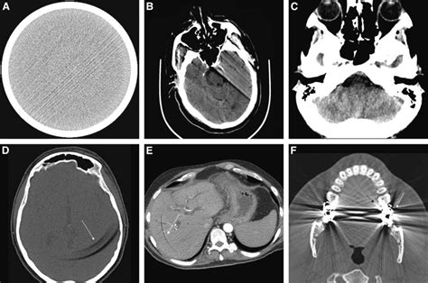 Cat Scan Image Artifacts