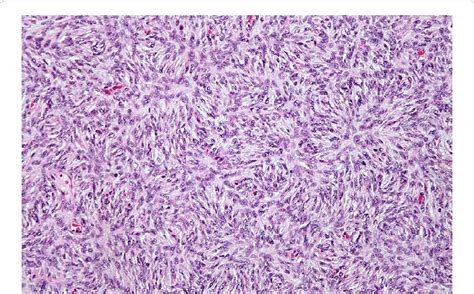 Fibrosis Has A Characteristic Storiform Pattern Typified By A