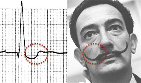 Digoxin Effect • Litfl • Ecg Library Toxicology