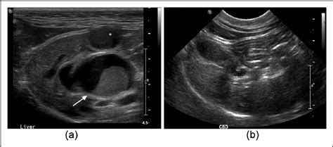 Cholangitis Ultrasound