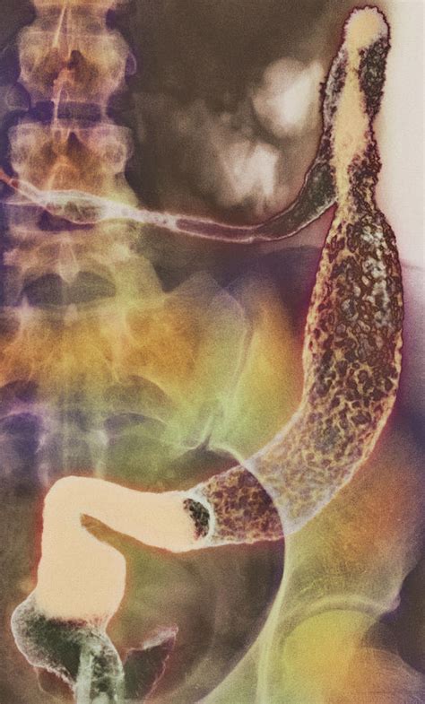 Ulcerative Colitis X Ray 1 Photograph By Cnri Science Photo Library