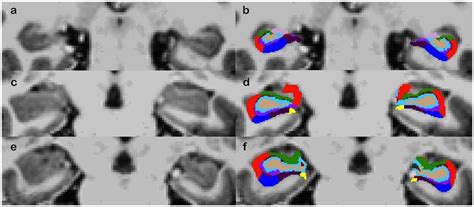 Hippocampal Subfields Segmentation Note Hippocampal Subfield Download Scientific Diagram