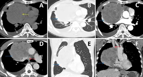 Frontiers Case Report Primary Mediastinal Ewings Sarcoma Presenting