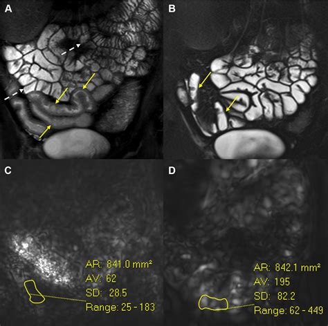 How I Do It Cross Sectional Imaging In Small Bowel Crohn Disease And