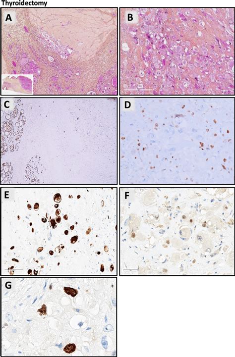 Thyroidectomy A Thyroid Parenchyma Totally Fibrotic With Rare Small