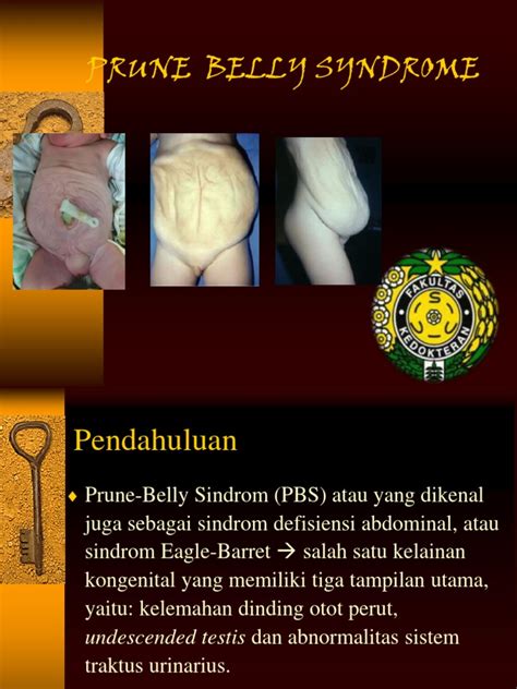 Prune Belly Syndrome Pdf