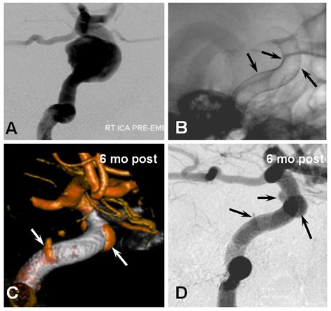 Pipeline Device Aneurysm Selection