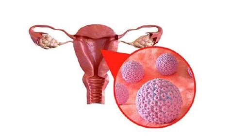 Genital Wart Removal Treatment Types And Recovery Ck Birla Hospital