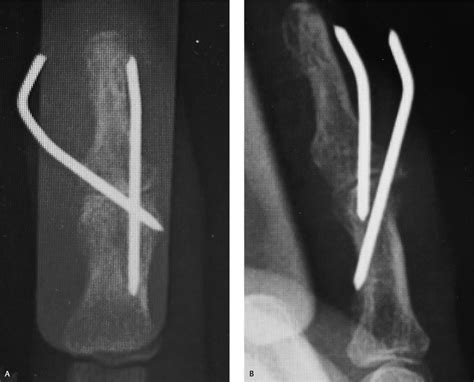 A Extension Block Pin Shown Deviating From The Center Of The Head Of Download Scientific