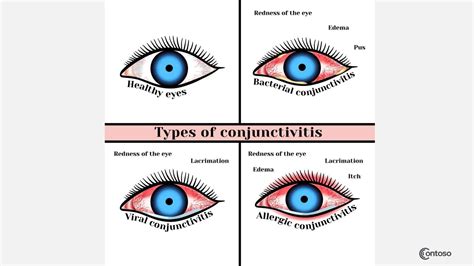 Conjunctivitis Its Types Clinical Manifestation And Nursing