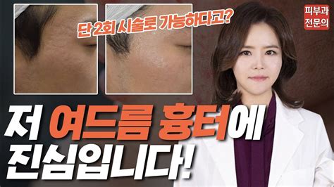 Eng Cn 여드름흉터 쥬베룩볼륨 도트필 피코프락셀 효과가 궁금하신가요 치료후기 닥터지니시술 Youtube