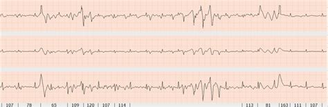 Non Sustained Ventricular Tachycardia Rpvcs