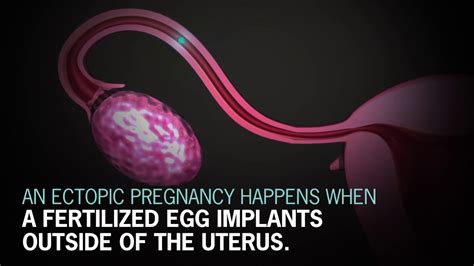 What Is Ectopic Pregnancy Youtube