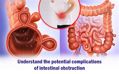 Understand The Potential Complications Of Intestinal Obstruction