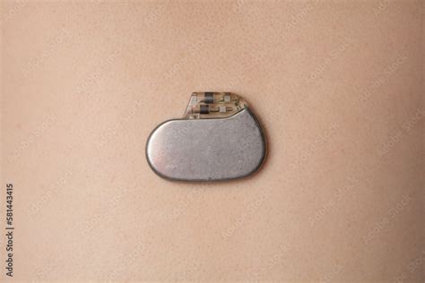 Photo Pacemaker On The Skin Surface Tamas Posters Tableaux Et Papiers Peints Europosters