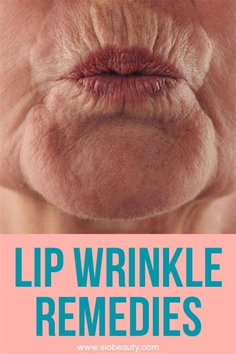 The 6 Best Upper Lip Wrinkle Treatments Lip Wrinkle Treatment Mouth