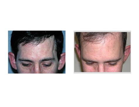 Temporal Augmentation Dr Barry Eppley Indianapolis Explore Plastic