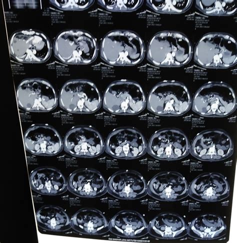 Process Purpose And Preparation For Abdominal Ct Scan Omega Pds Hot