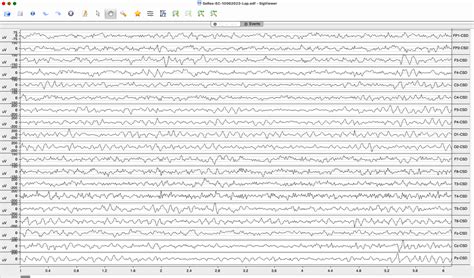 QEEG Brain Mapping Peak Brain Institute