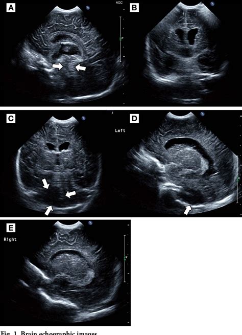 Table 1 From Brain Echo Imaging Of Posterior Fossa Subdural Hematoma In